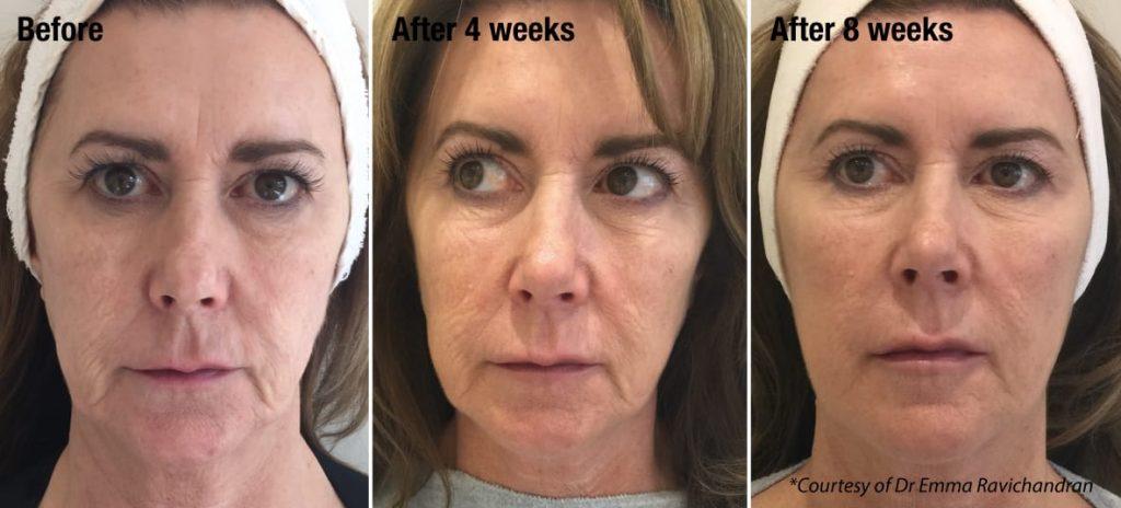 PROFHILO 3 months on - Somerset Cosmetic Clinic