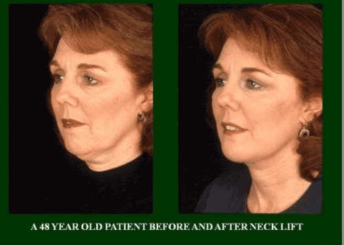 The Nerfertiti lift for the perfect neckline and smoothness of jaw