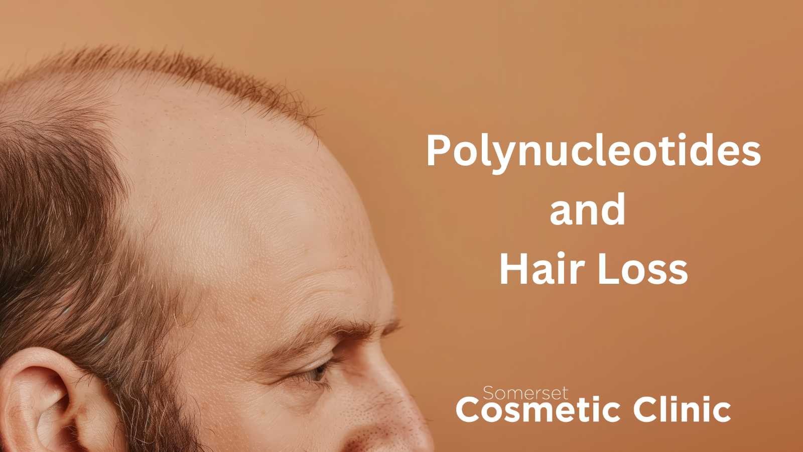 Polynucleotides and Hair Loss - Somerset Cosmetic Clinic