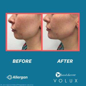 The New 7 Point Face Lift - Somerset Cosmetic Clinic