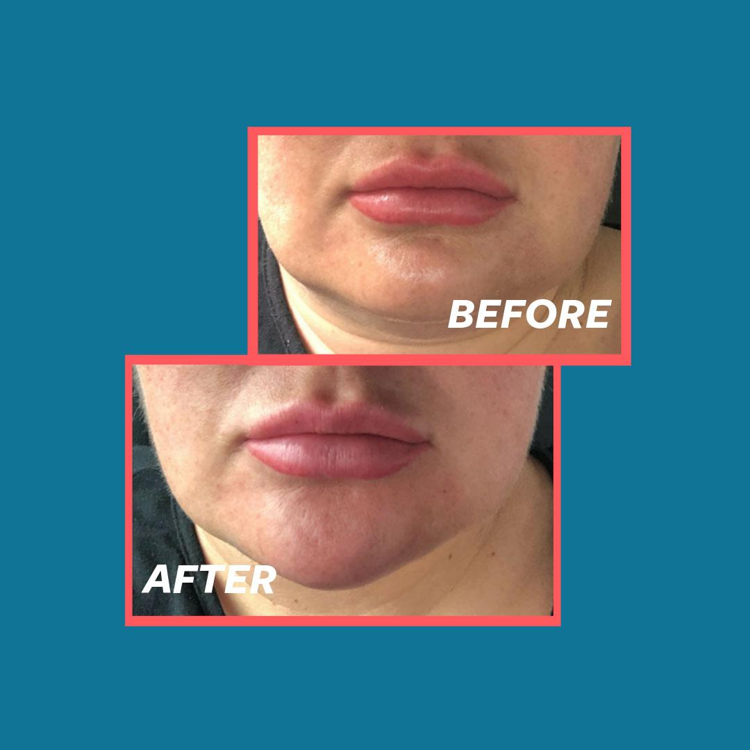 The New 7 Point Face Lift - Somerset Cosmetic Clinic