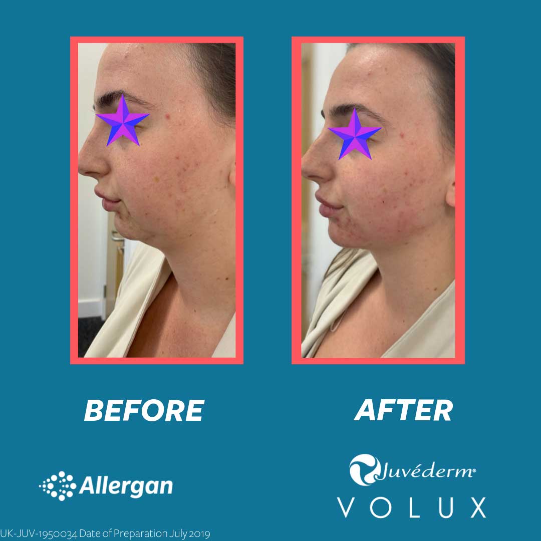 The New 7 Point Face Lift - Somerset Cosmetic Clinic